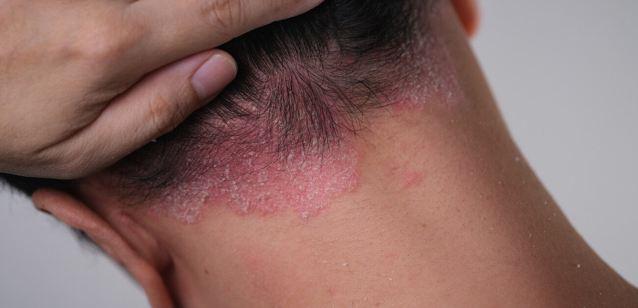 Find Relief from Psoriasis This Winter - Mosaic Dermatology